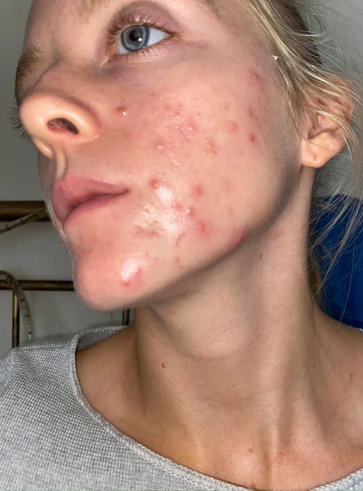 100% Natural Acne Supplement – PORE FAVOR AU