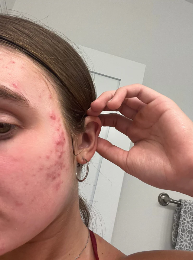 100% Natural Acne Supplement – PORE FAVOR AU